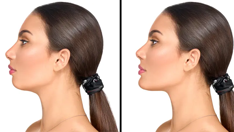 A Patient's Guide to Affordable Face Contouring in South Korea