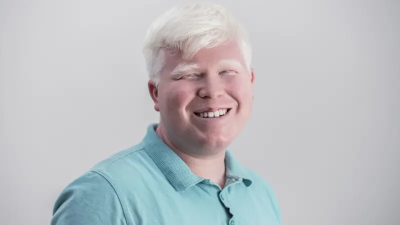 Understanding Albinism: A Complete Guide to Causes, Symptoms, and ...