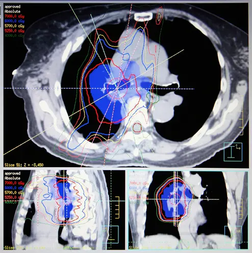 IMRT (Intensity-Modulated Radiation Therapy)