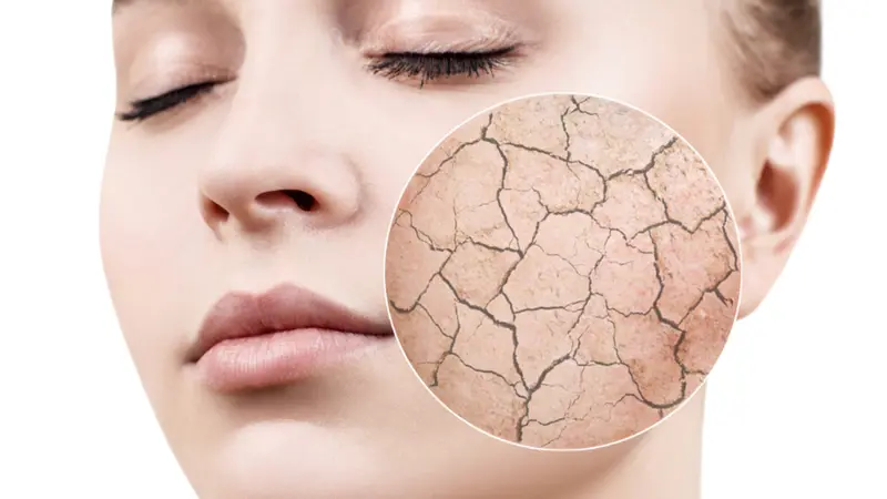 What is Dry Skin & How To Prevent It?