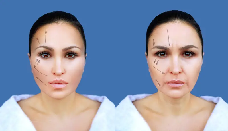 Non-Incisional Ptosis Correction