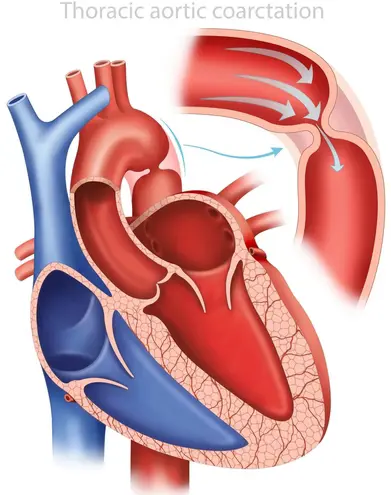 Procedimiento de Stent para COA (Coartación de la Aorta)