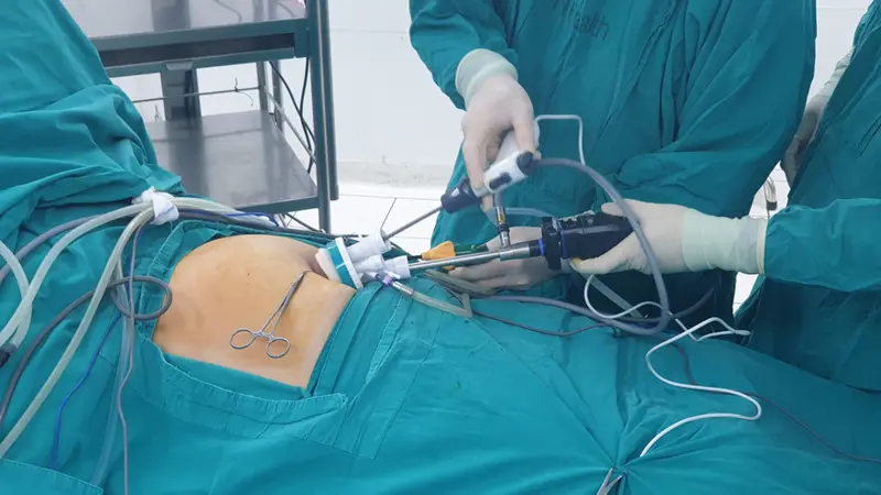 Single-Incision Laparoscopic Surgery Single-Incision Laparoscopic Surgery