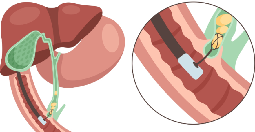 Endoscopic Papillosphincterotomy Procedure