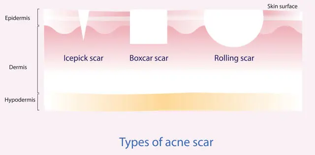 Acne Scar Treatment