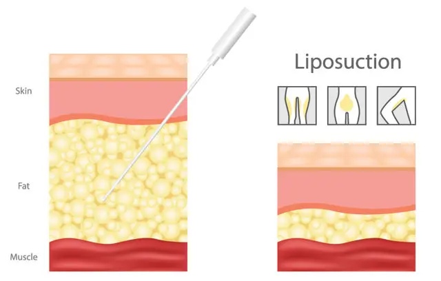 Body Fat Reduction Surgery (Liposuction)