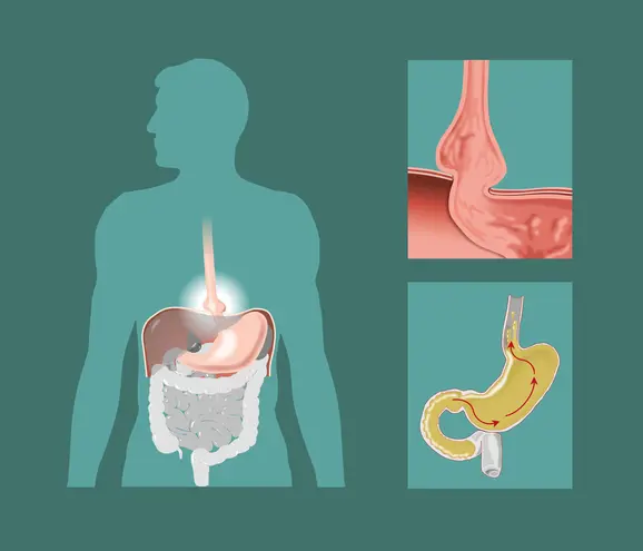 Stomach Hernia (Gastrocele) Treatment