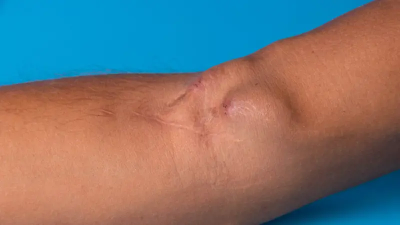 A Patient's Comprehensive Guide to Your Arteriovenous (AV) Fistula