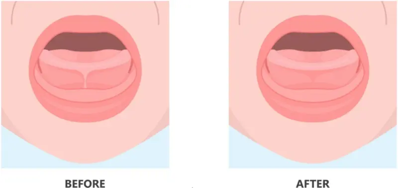 Frenectomy: Benefits, Procedure, and Recovery Explained