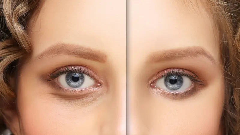 A Patient's Guide to Affordable Under-Eye Fat Transfer in South Korea