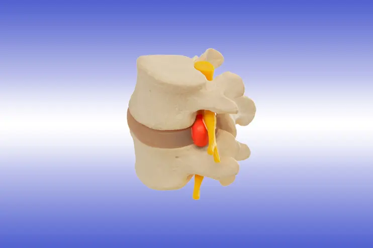 Cervical Herniated Disc Treatment