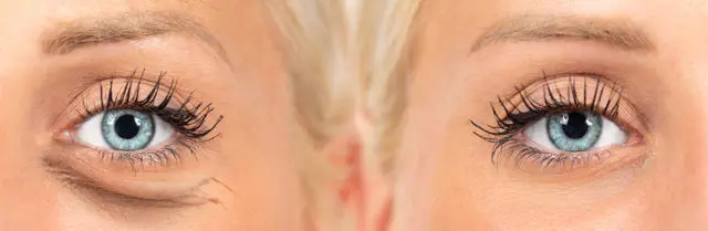 Lower Eyelid Surgery: Expert Insights and What Patients Should Know