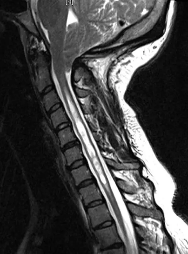 Syringomyelia Diagnosis and Care