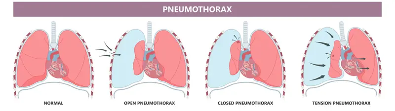 Tratamiento del neumotórax