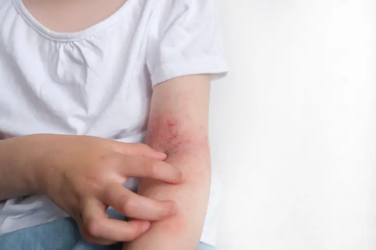 dermatosis