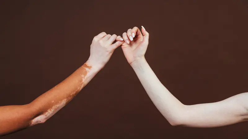 Understanding Albinism: A Complete Guide to Causes, Symptoms, and ...