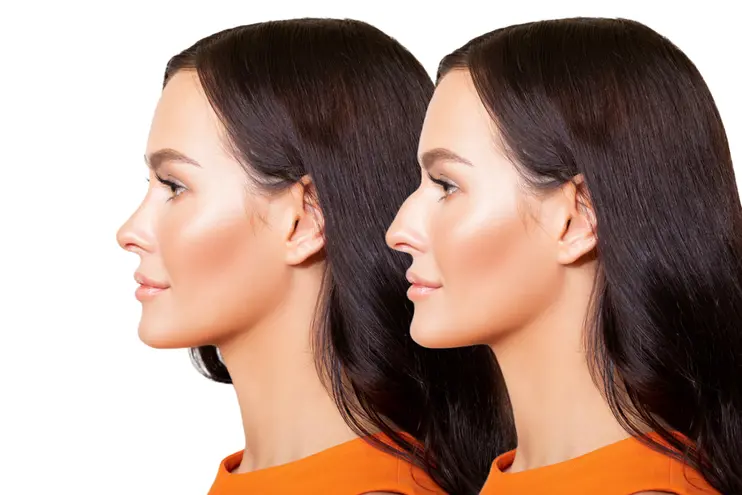 Curved Nose Correction Surgery