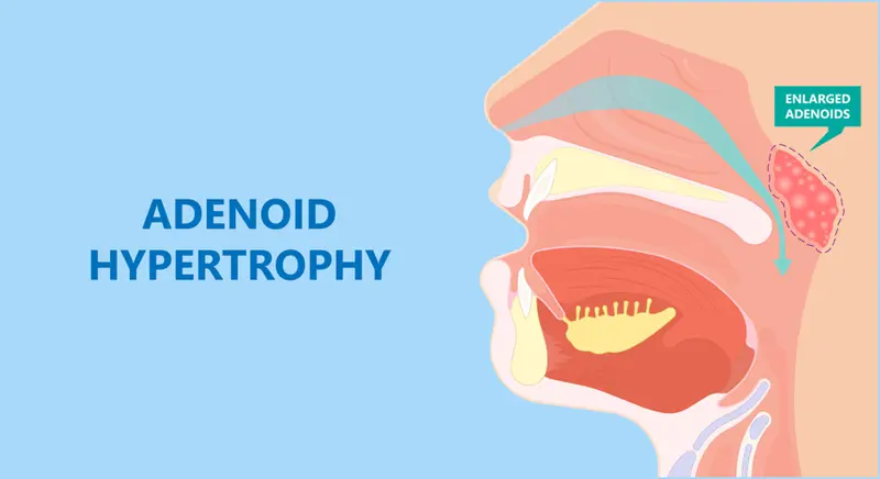 Cirugía endoscópica de adenoides