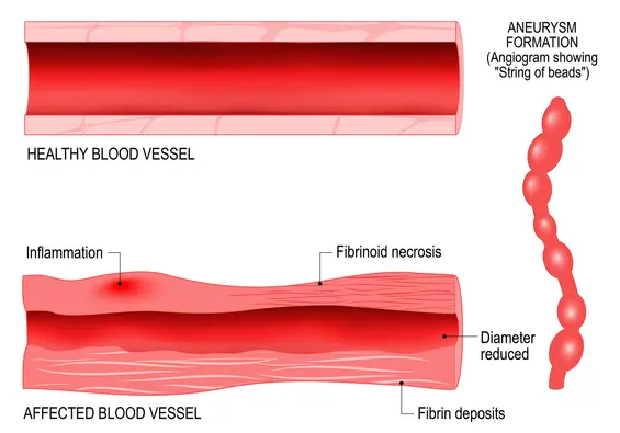 Vasculitis (inflammation of blood vessels)
