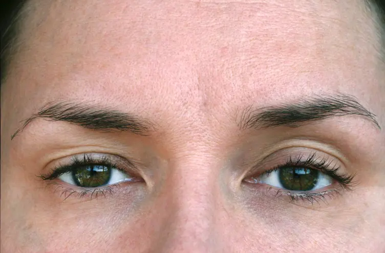 Non-Incisional Ptosis Correction