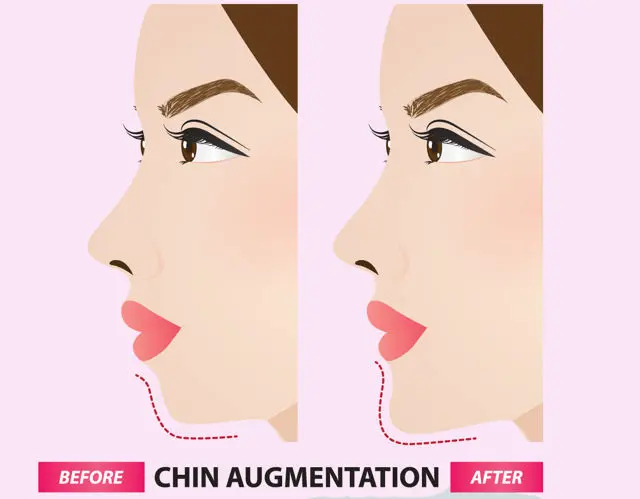 Chin Augmentation for Short Chin