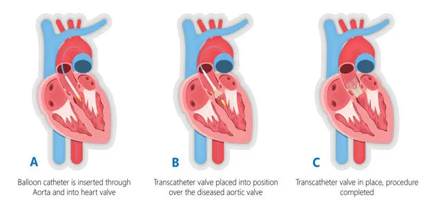 Interventional Cardiology