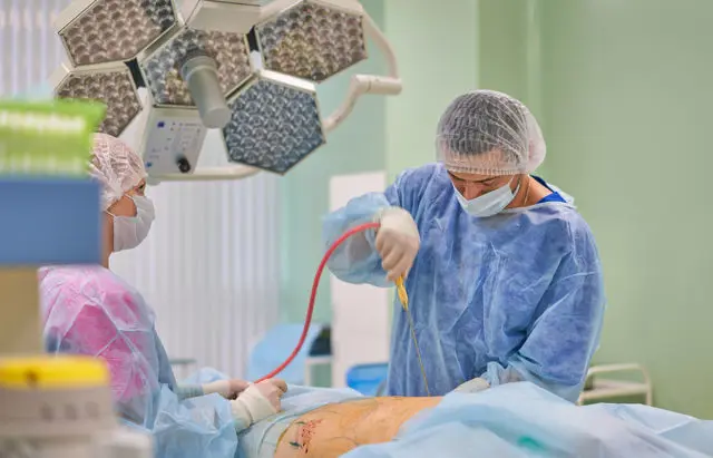 Body Fat Reduction Surgery (Liposuction)