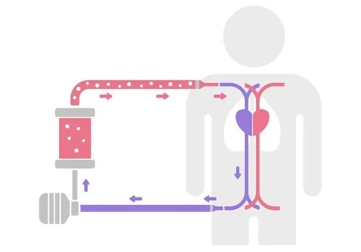ECMO Life Support Therapy