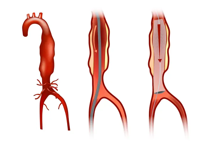 Thoracic endovascular aortic repair (TEVAR) Thoracic endovascular aortic repair (TEVAR)