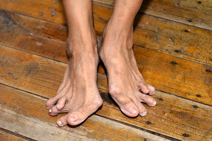 Operasi Koreksi Deformitas Sendi