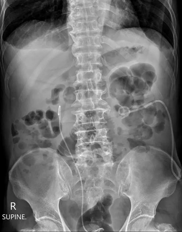 PCNL (Percutaneous Kidney Stone Surgery)