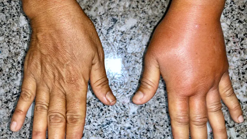 Angioedema: Causes, Types & Treatments