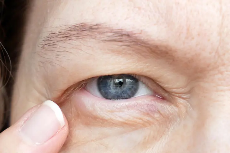 Non-Incisional Ptosis Correction