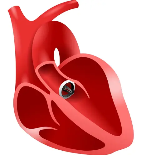 Double Heart Valve Replacement Surgery