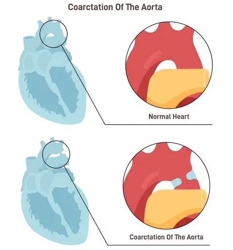 Aortic Coarctation