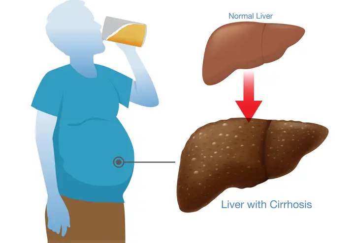 Ascites: A Complete Guide to Causes, Symptoms, and Treatment Options