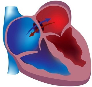 ASD (Atrial Septal Defect) Repair