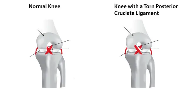 Cruciate Ligament Reconstruction Surgery