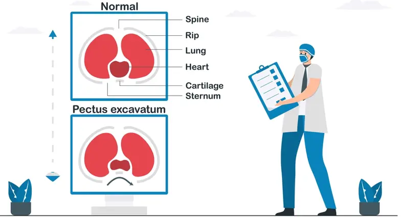 Corrección del Pecho En Embudo (Pectus Excavatum)