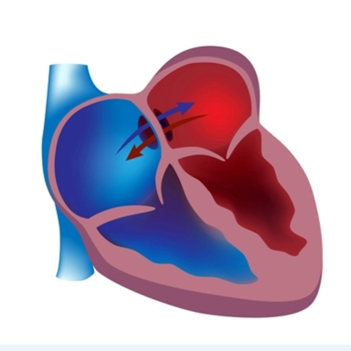 ASD (Atrial Septal Defect) Repair