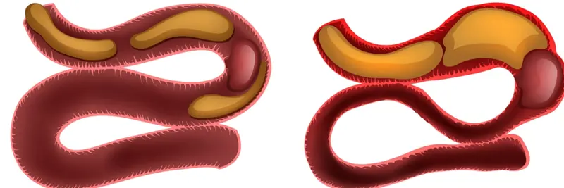 Small Bowel Obstruction Surgery