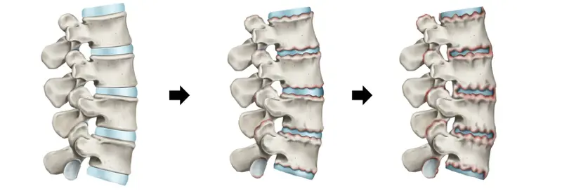 Spinal Disorders (Spondylopathy) Management