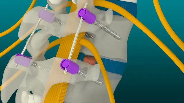 Lumbar Disc Fusion Surgery