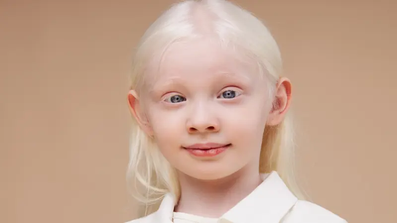 Understanding Albinism: Causes, Symptoms, Types, and Effective ...