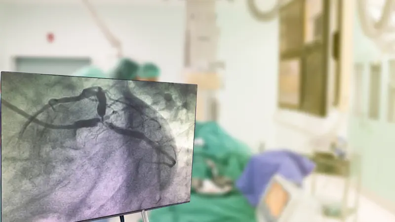 ICP (Intervención Coronaria Percutánea)