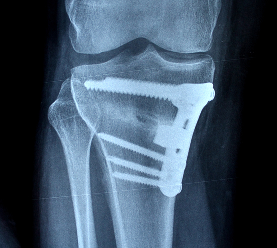 Bone Reshaping Surgery (Osteotomy)