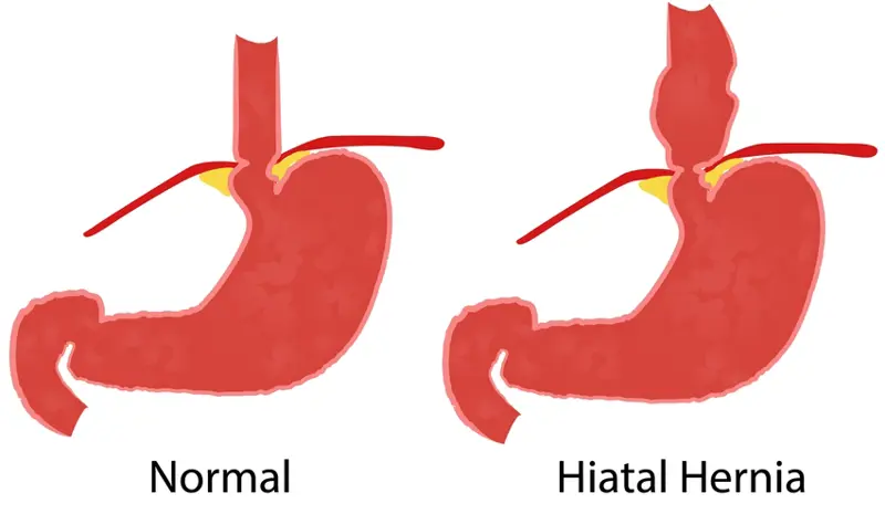 Stomach Hernia (Gastrocele) Treatment