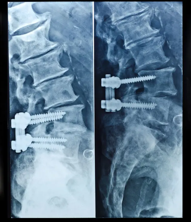 ALIF Spine Surgery