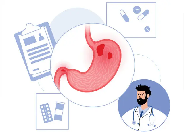 3 Things You Didn’t Know About Stomach Ulcers and How to Manage Them