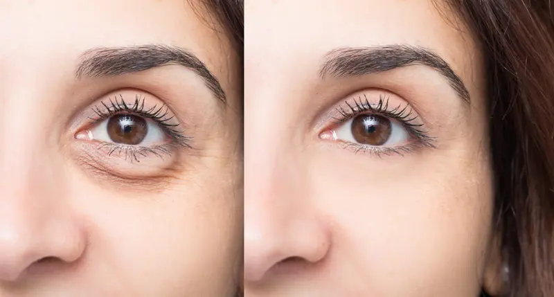 Canthopexy: A Comprehensive Patient Guide to Eyelid Lifting and ...
